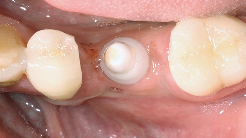 How titanium implants act as antennas for electromagnetic fields | DNA