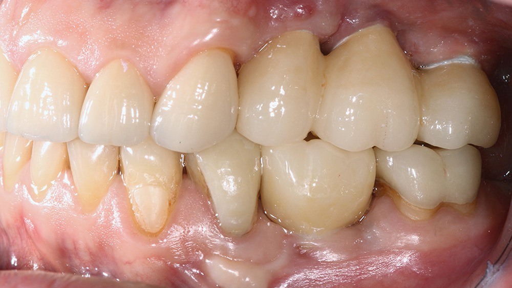 How titanium implants act as antennas for electromagnetic fields | DNA